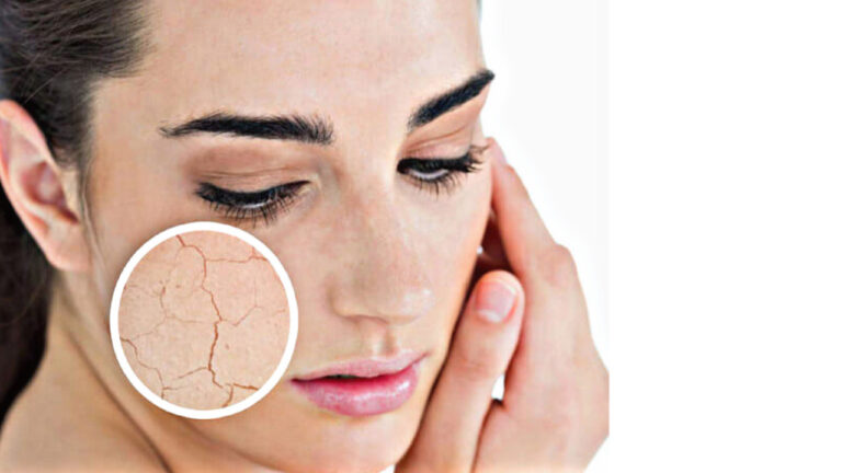 Home remedies: Say goodbye to dry skin this winter! Try these tips
