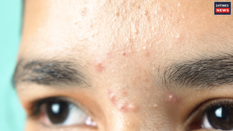 Worried about Pimple marks on face? Try these easy home remedies today